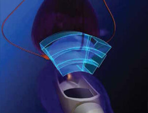 HIFU - Prostate Cancer Treatment Using Ultasound Energy